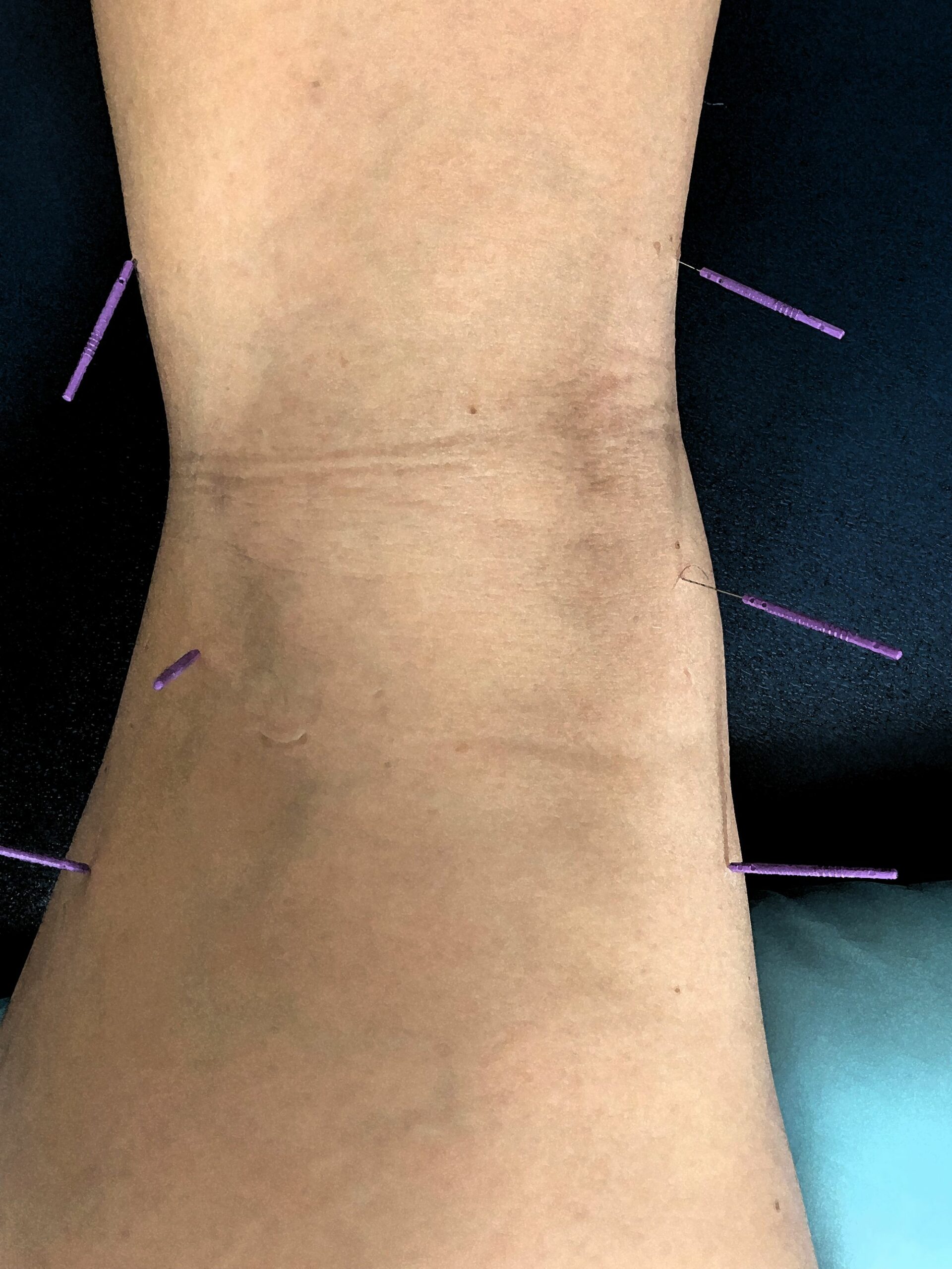 Popliteus Dry Needling for Low Back Pain, Knee Pain & Plantar Fasciitis ...